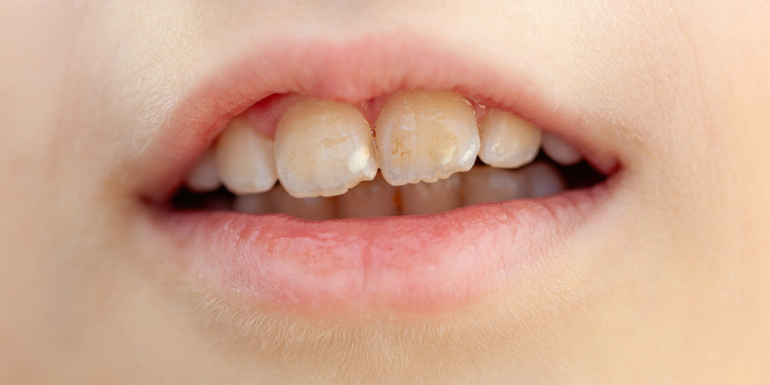 Brown stains on teeth – where do they come from and how to remove tooth ...