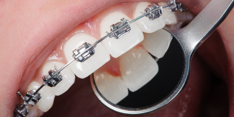 What is a scissor bite and how is this malocclusion treated? Causes and ...